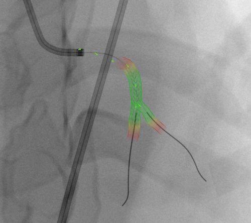 Coronary Advanced | Software